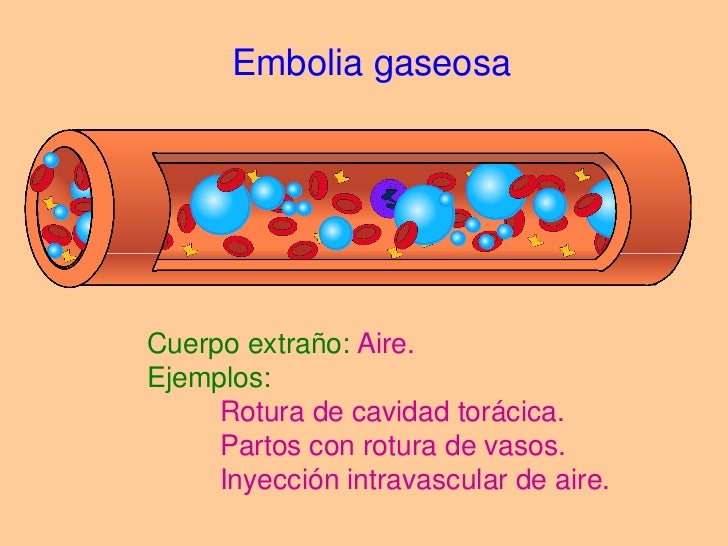 Embolia pulmonar Síntomas y Tratamientos