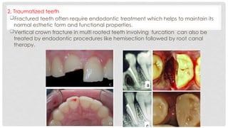 7- Endodontic case fffffv complexity.pptx