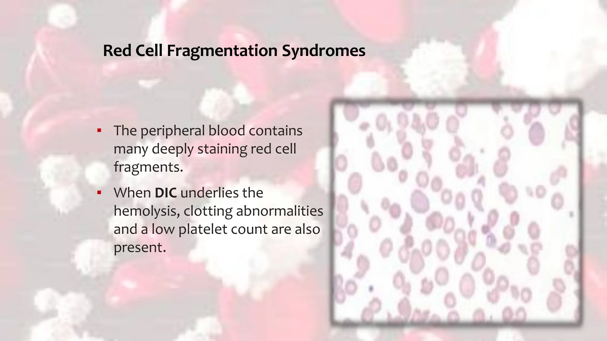 7-Haemolytic anaemias a sub-type of anemia, a common blood disorder .pdf