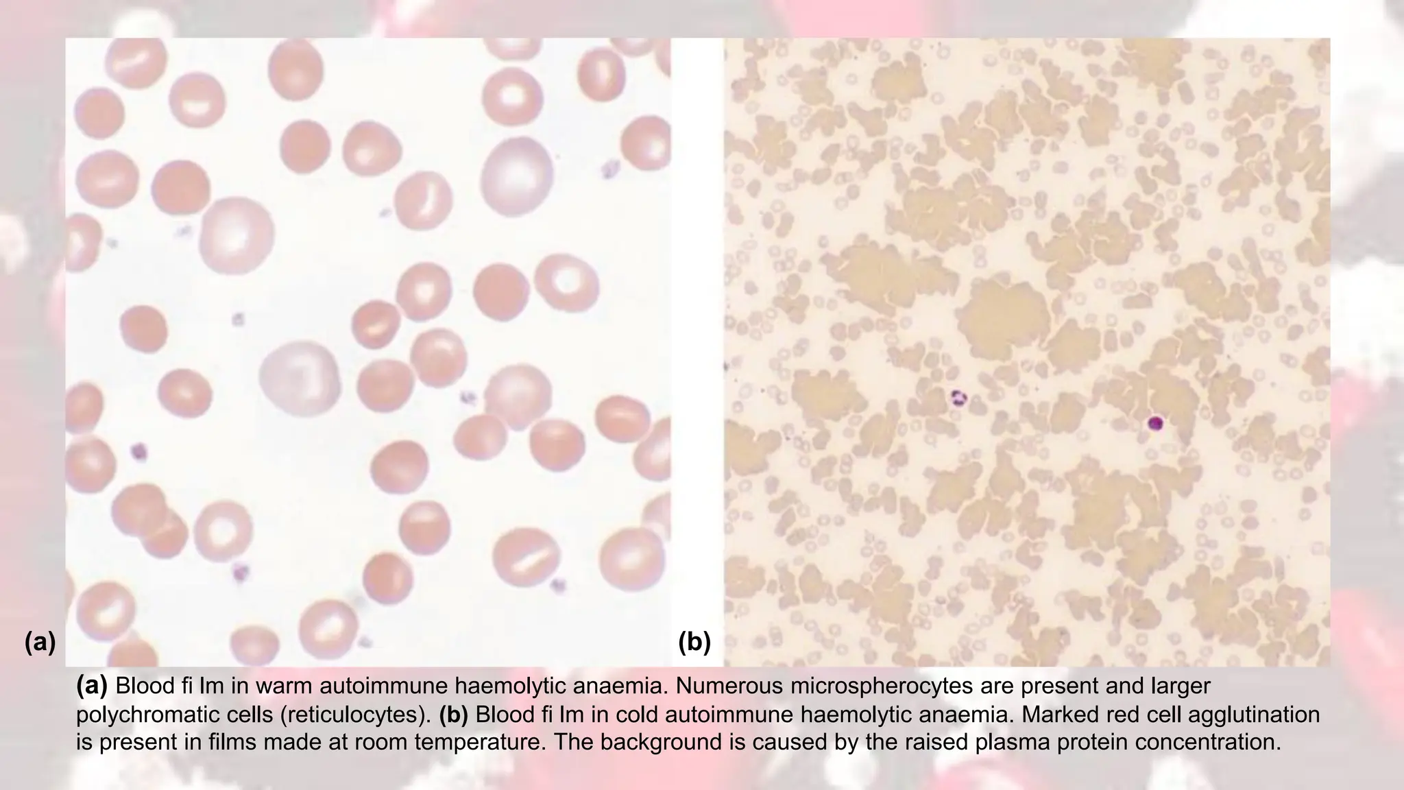 7-Haemolytic anaemias a sub-type of anemia, a common blood disorder .pdf