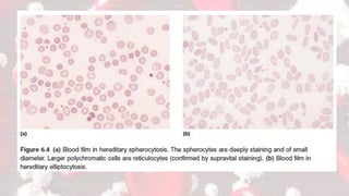 7-Haemolytic anaemias a sub-type of anemia, a common blood disorder .pdf