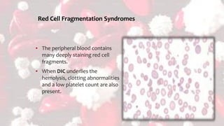 7-Haemolytic anaemias a sub-type of anemia, a common blood disorder .pdf
