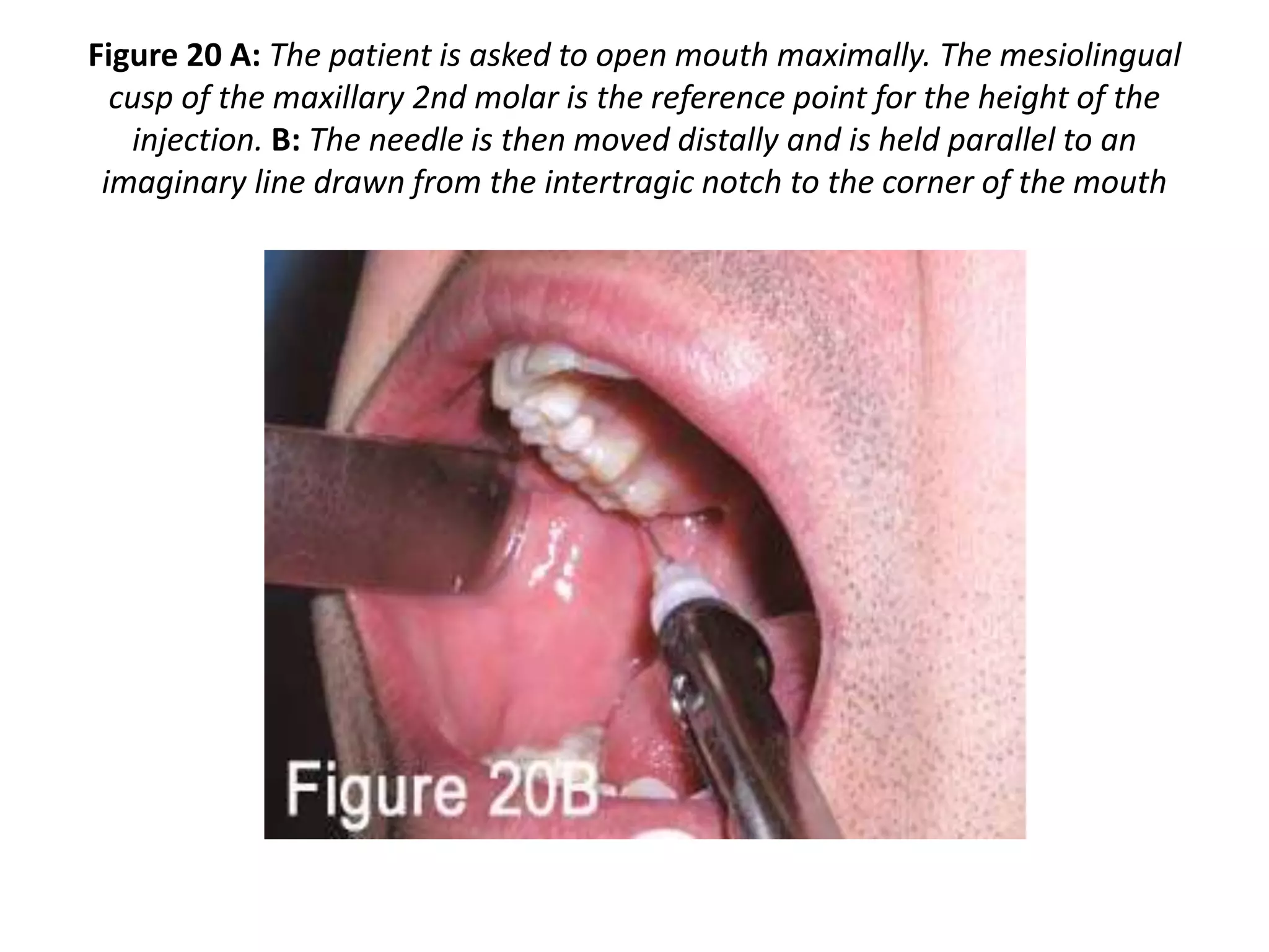 mandibular nerve-block | PPTX