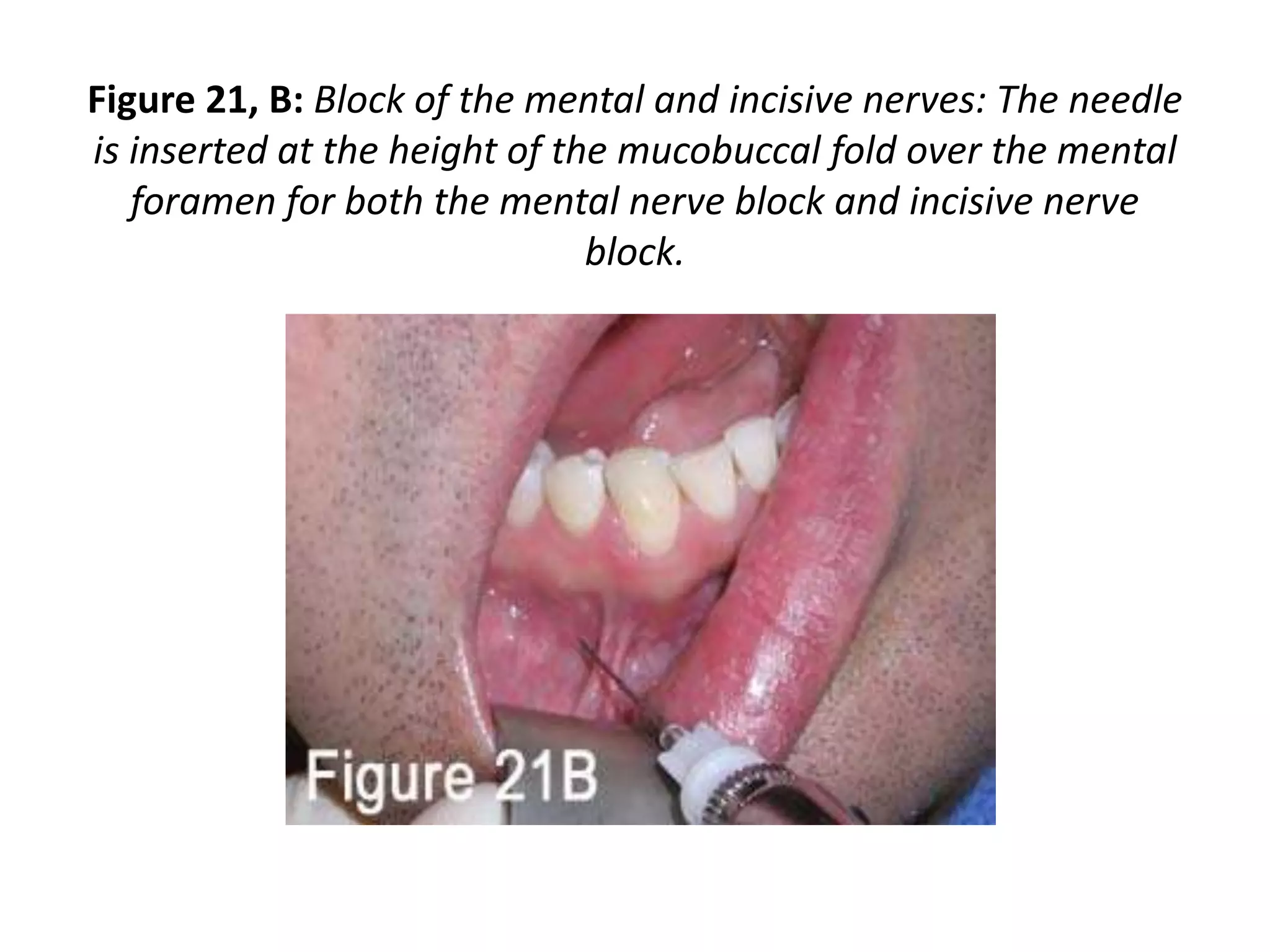 mandibular nerve-block | PPTX