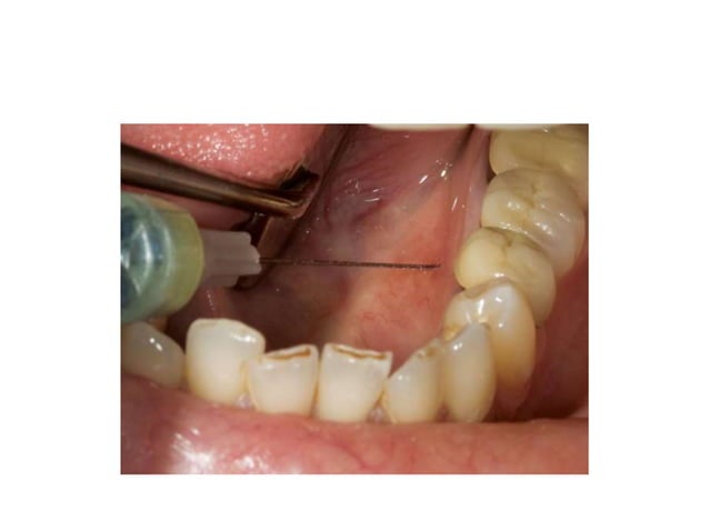 mandibular nerve-block | PPTX
