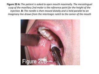 mandibular nerve-block | PPTX