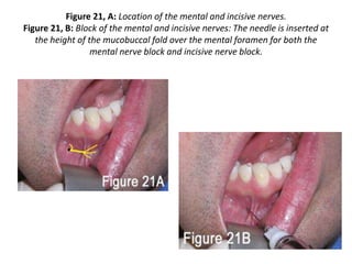 mandibular nerve-block | PPTX