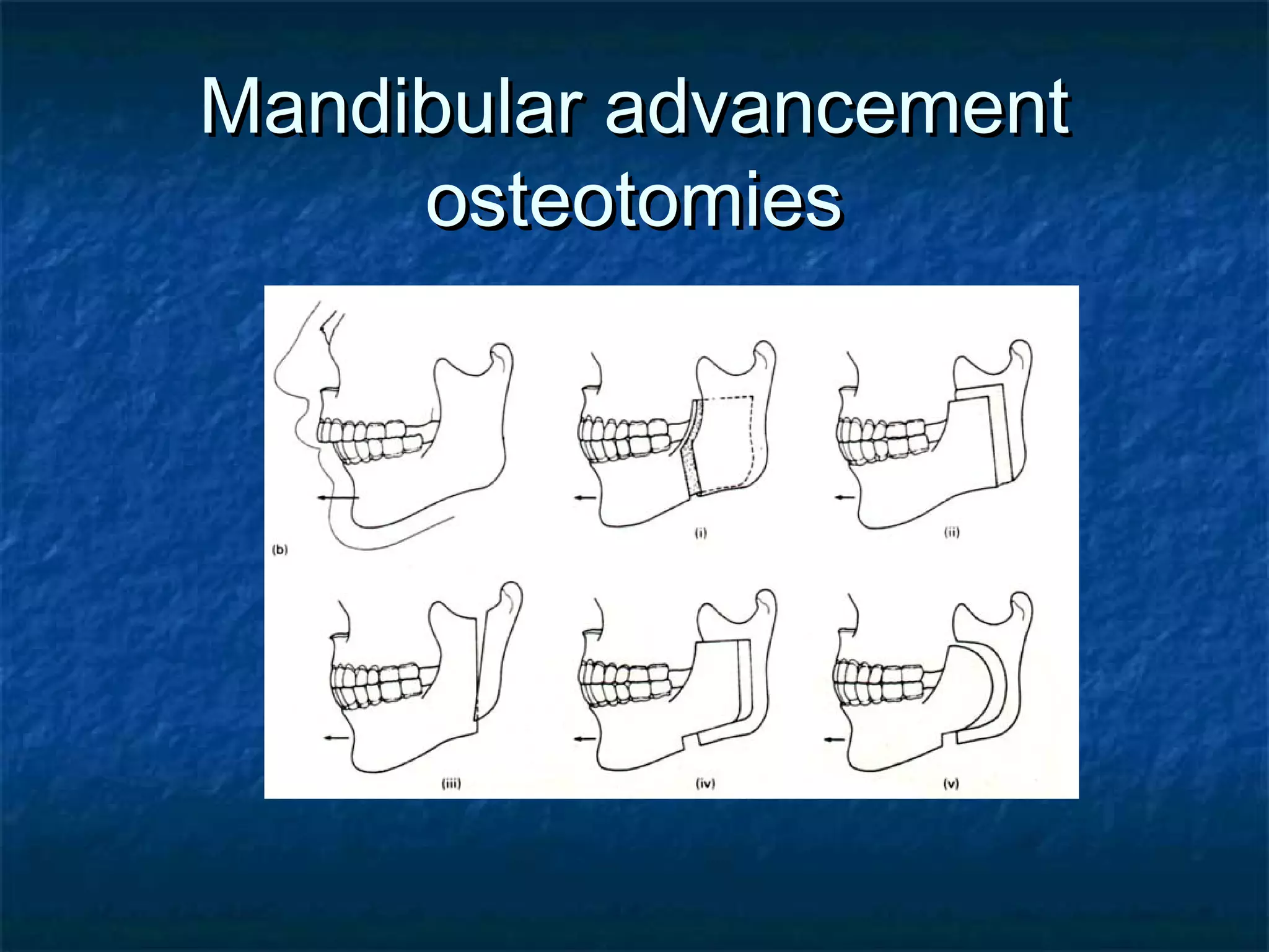 7 mandibular osteotomies | PPT