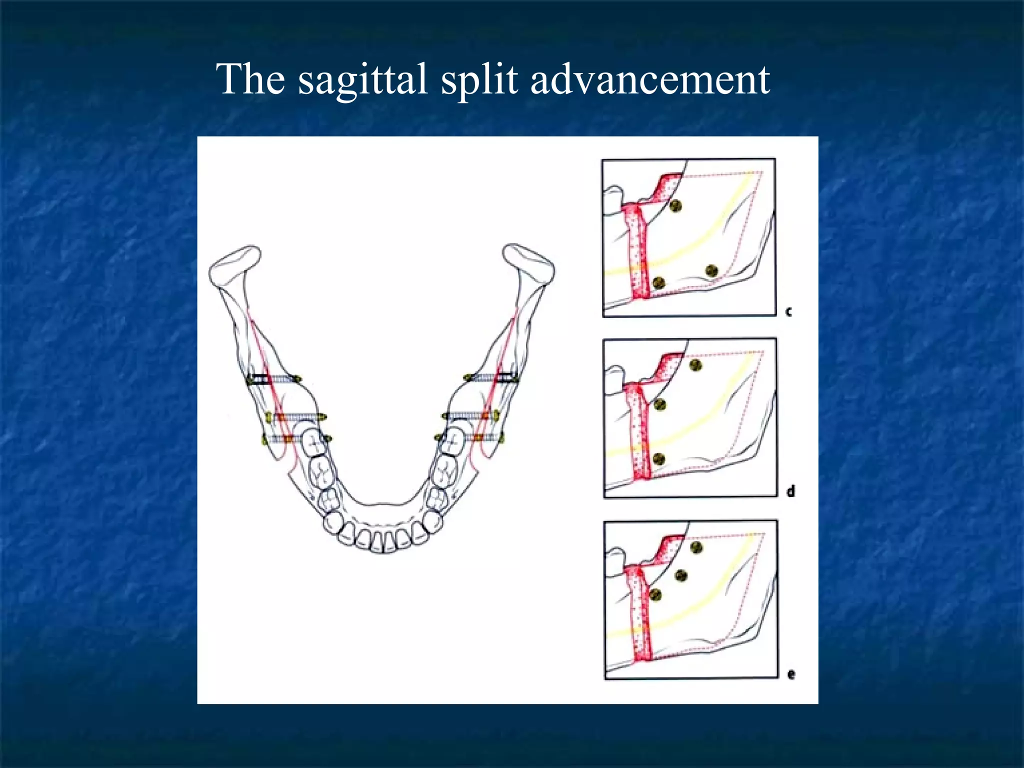 7 mandibular osteotomies | PPT