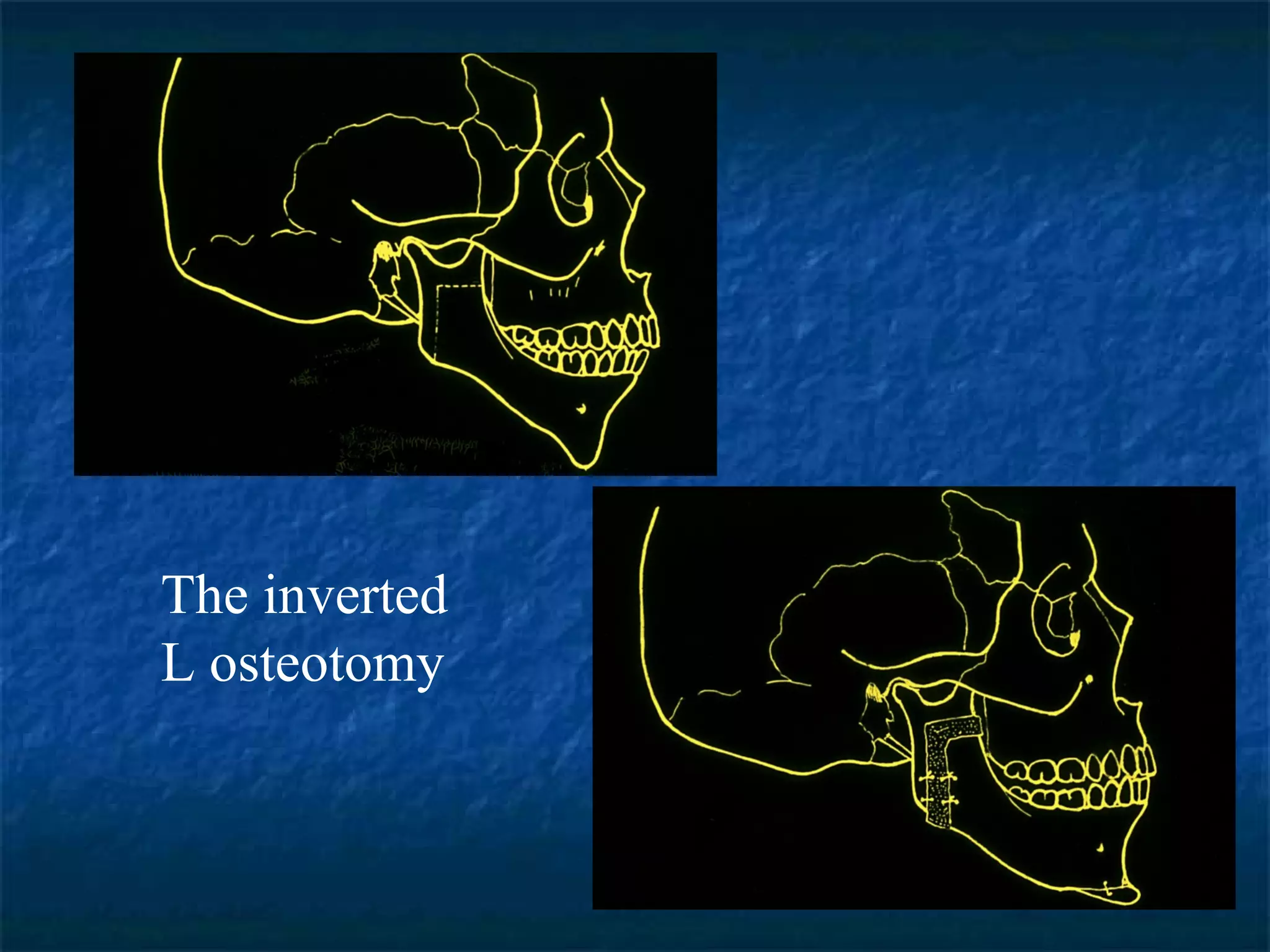 7 mandibular osteotomies | PPT