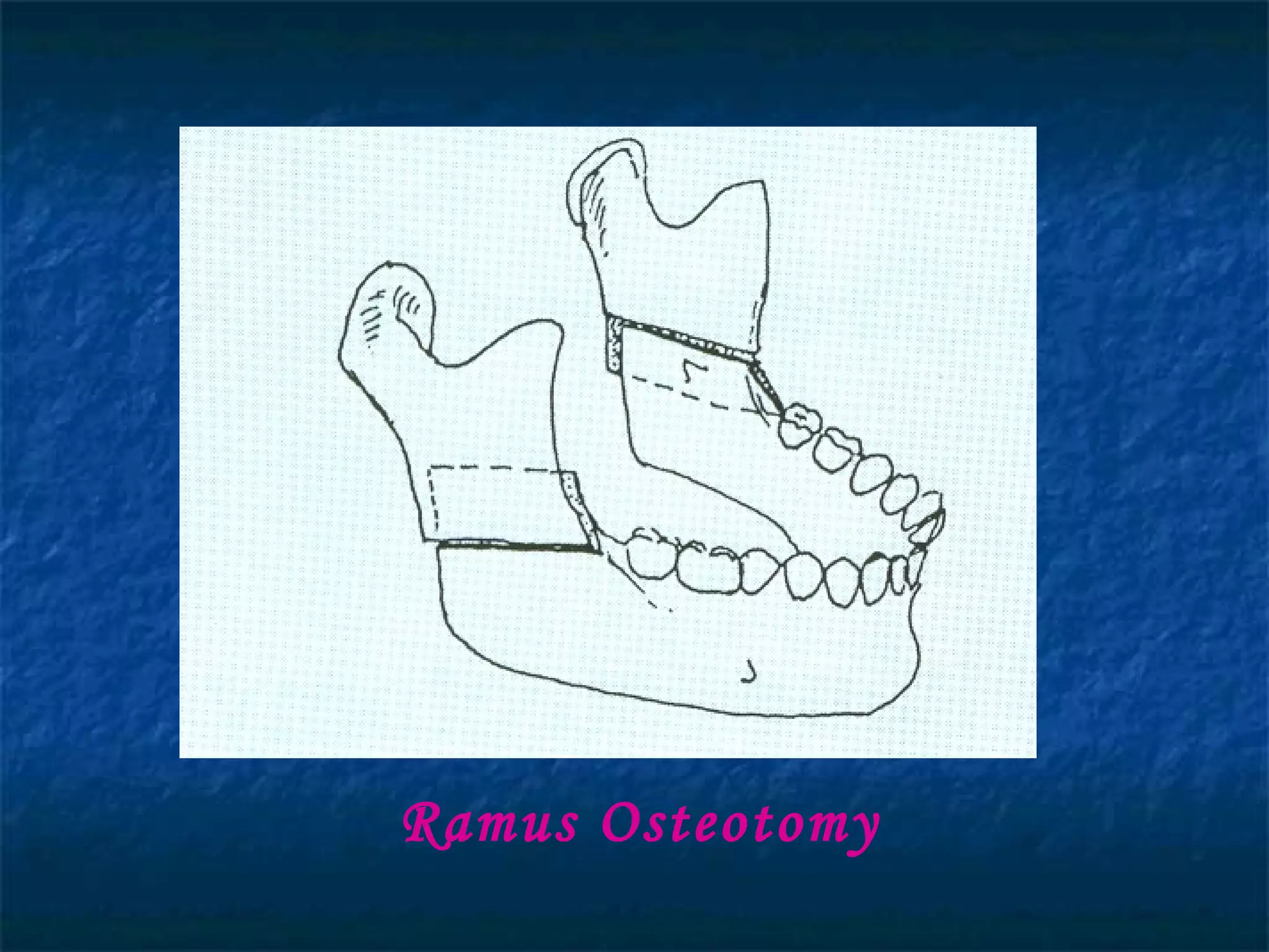 7 mandibular osteotomies | PPT