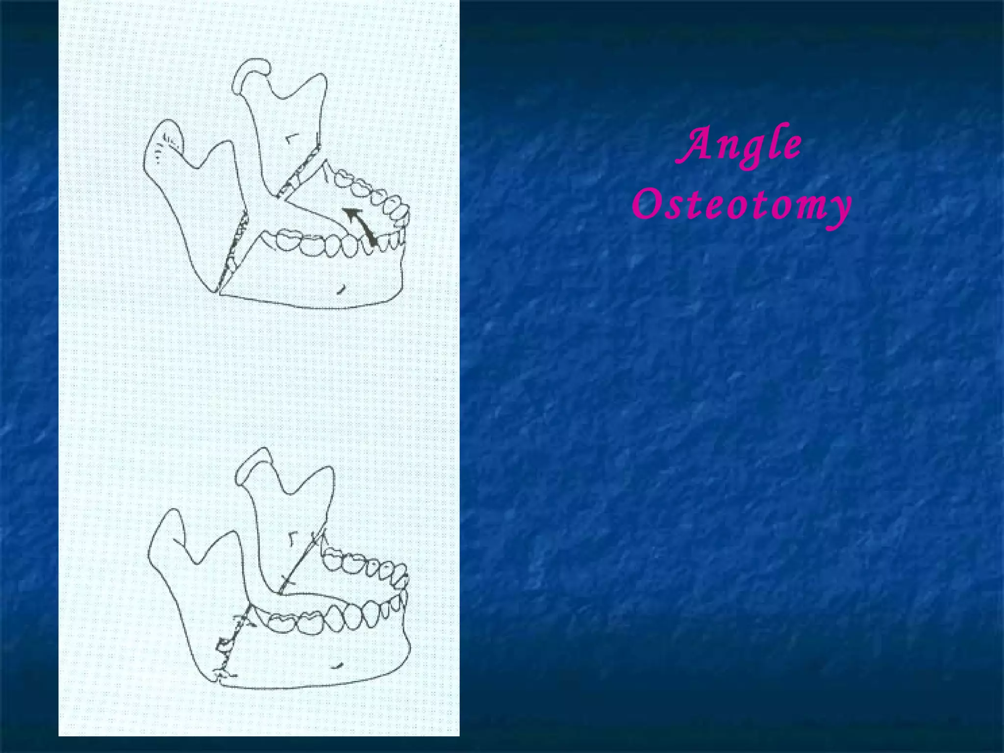 7 mandibular osteotomies | PPT