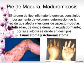 7.micetoma | PPT