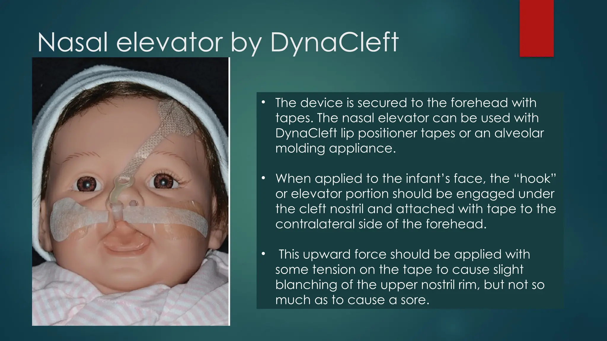 NASO ALVEOLAR MOULDNIG IN CLEFT LIP AND PALATE PATIENT | PPTX