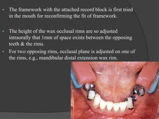 Occlusion in Removable Partial Dentures | PPTX