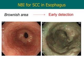 Endoscopy in Gastrointestinal Oncology - Slide 7 - I. Oda - Chromoscopy ...