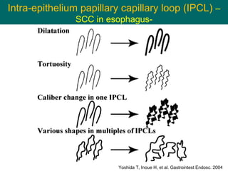 Endoscopy in Gastrointestinal Oncology - Slide 7 - I. Oda - Chromoscopy ...