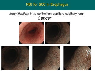 Endoscopy in Gastrointestinal Oncology - Slide 7 - I. Oda - Chromoscopy ...