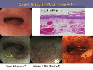 Endoscopy in Gastrointestinal Oncology - Slide 7 - I. Oda - Chromoscopy ...