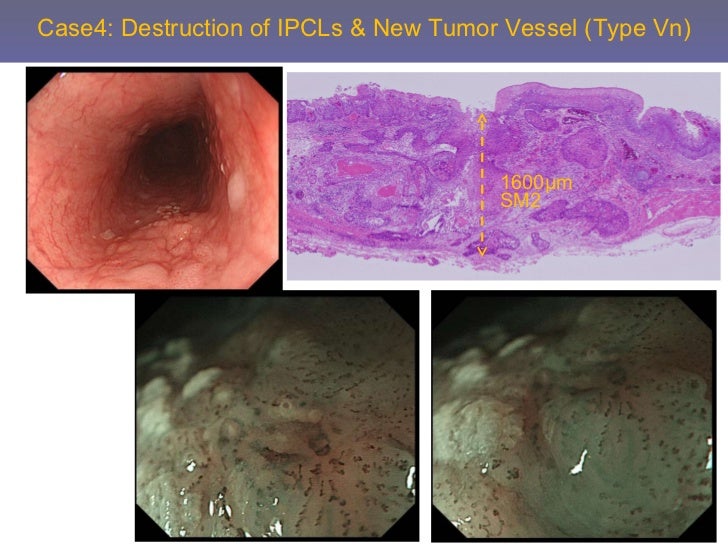Endoscopy in Gastrointestinal Oncology - Slide 7 - I. Oda - Chromosco…