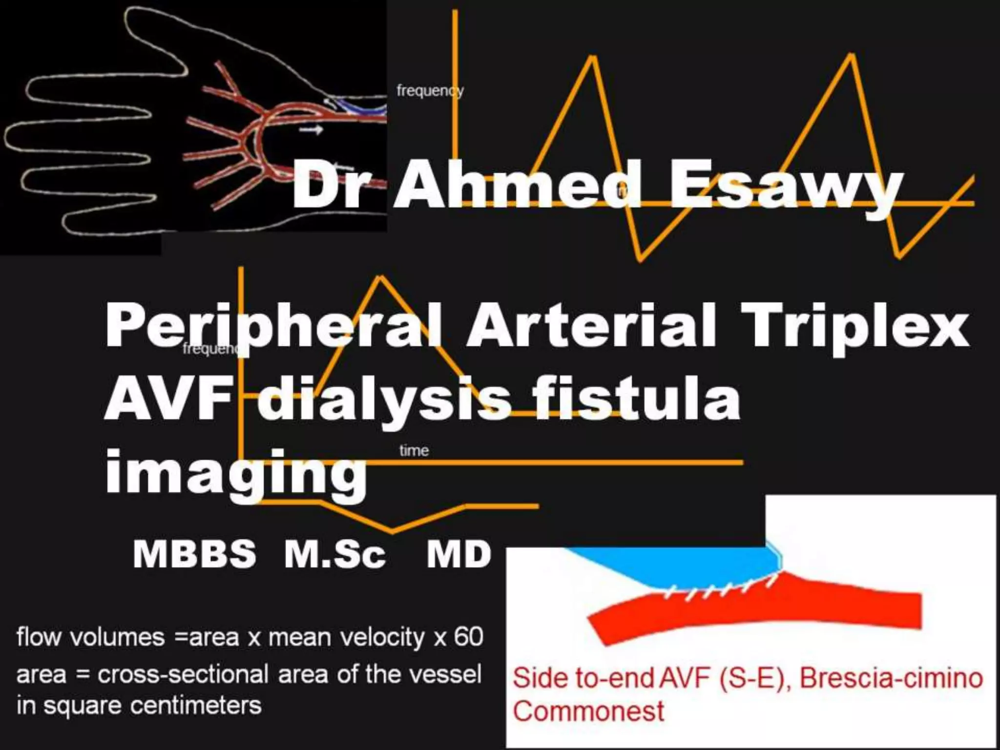 7 peripheral arterial triplex ultrasound dialysis avf triplex ultrasound dr ahmed esawy | PPTX