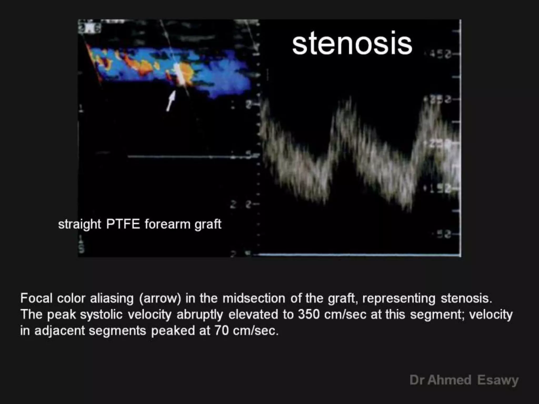 7 peripheral arterial triplex ultrasound dialysis avf triplex ...