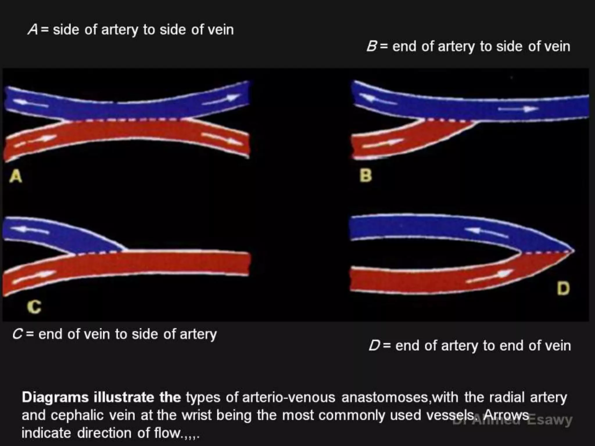 7 peripheral arterial triplex ultrasound dialysis avf triplex ...