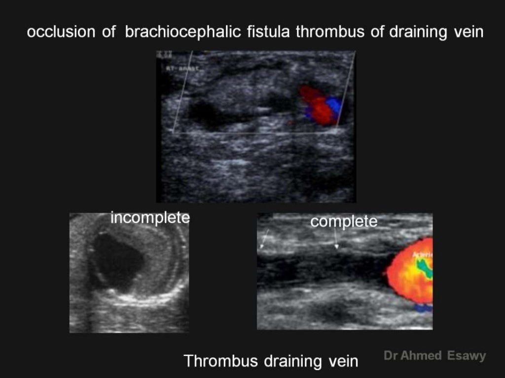 7 peripheral arterial triplex ultrasound dialysis avf triplex ultras…