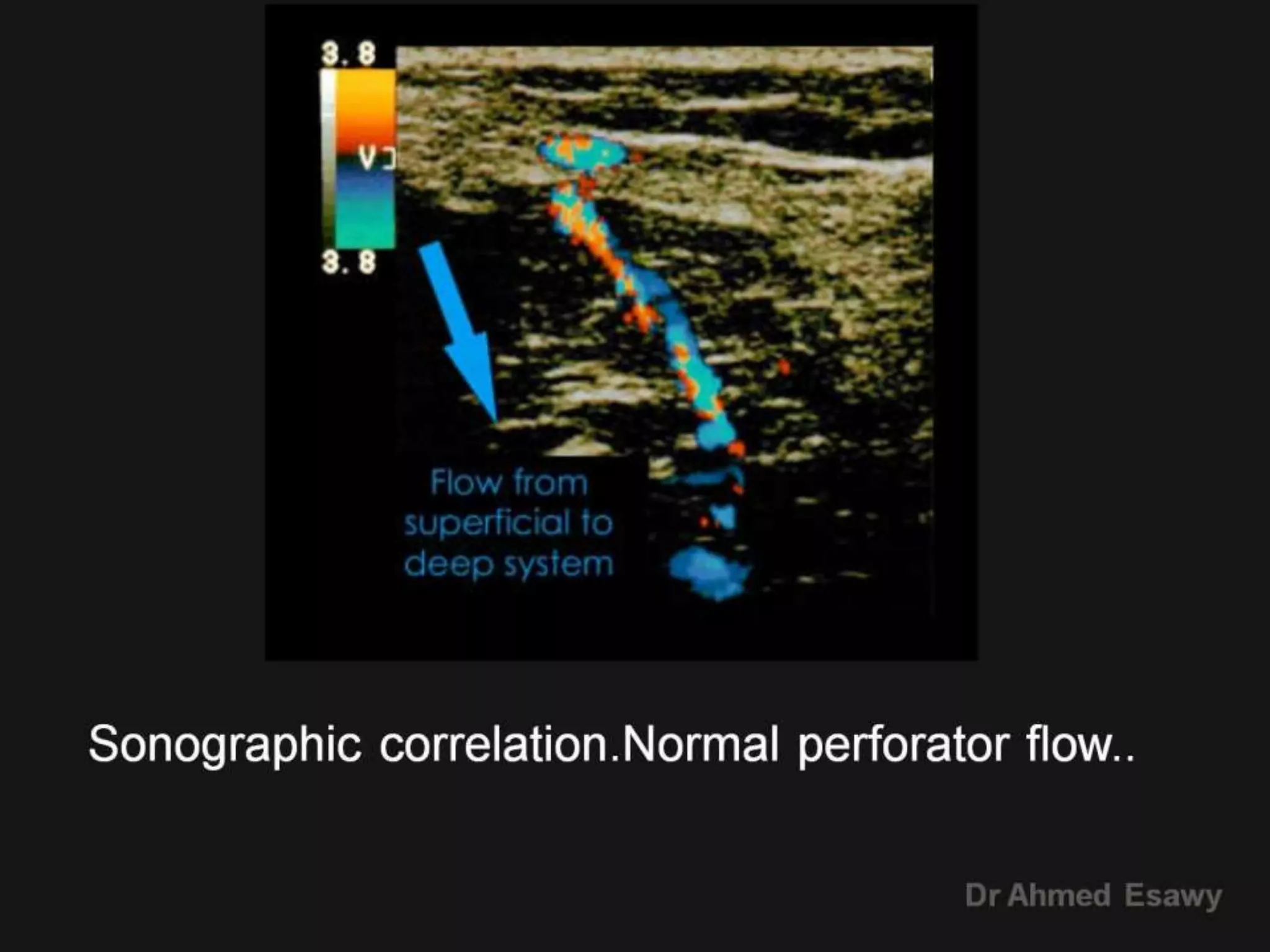 7 peripheral venous duplex perforating veins anatomy dr ahmed esawy | PPTX