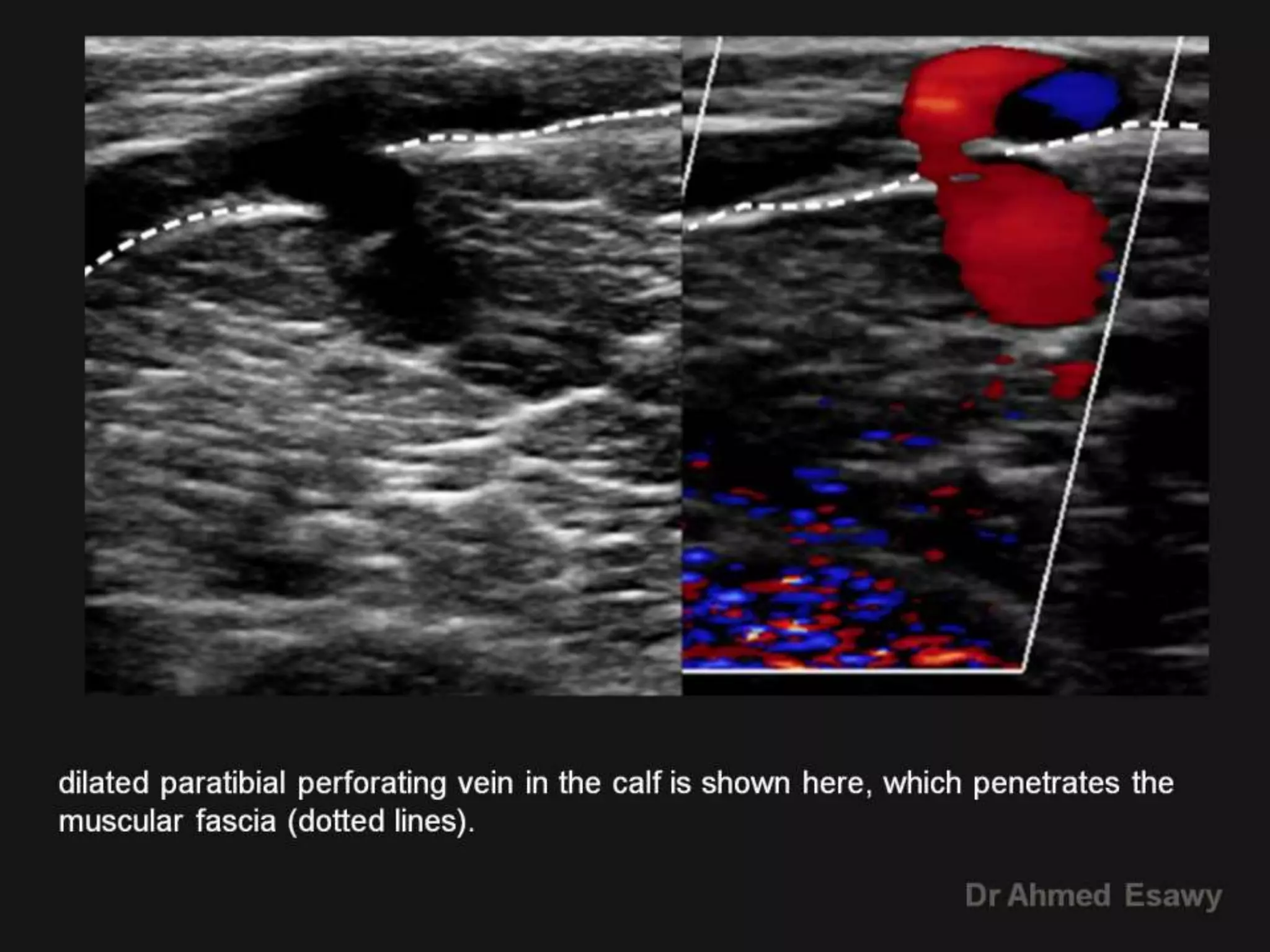 7 peripheral venous duplex perforating veins anatomy dr ahmed esawy | PPTX