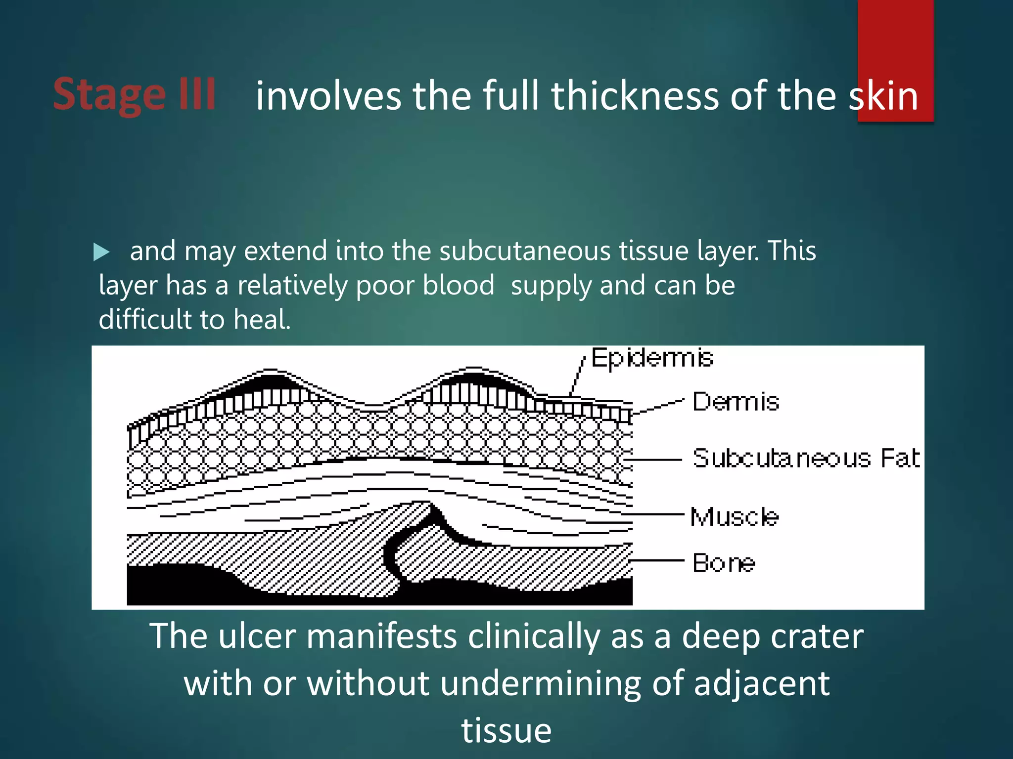 7- PT pressure ulcers.pptx