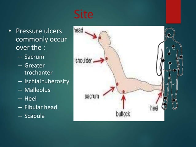 7- PT pressure ulcers.pptx