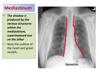 7- Radiological Anatomy of Thorax....pdf