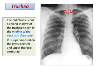 7- Radiological Anatomy of Thorax....pdf