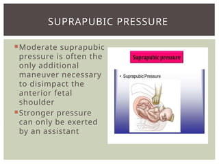 7-Shoulder_dystocia[1].pptx5555555555555555555555 | PPT