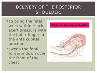 7-Shoulder_dystocia[1].pptx5555555555555555555555 | PPTX