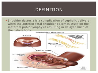 7-Shoulder_dystocia[1].pptx5555555555555555555555 | PPTX
