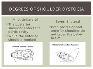 7-Shoulder_dystocia[1].pptx5555555555555555555555 | PPTX
