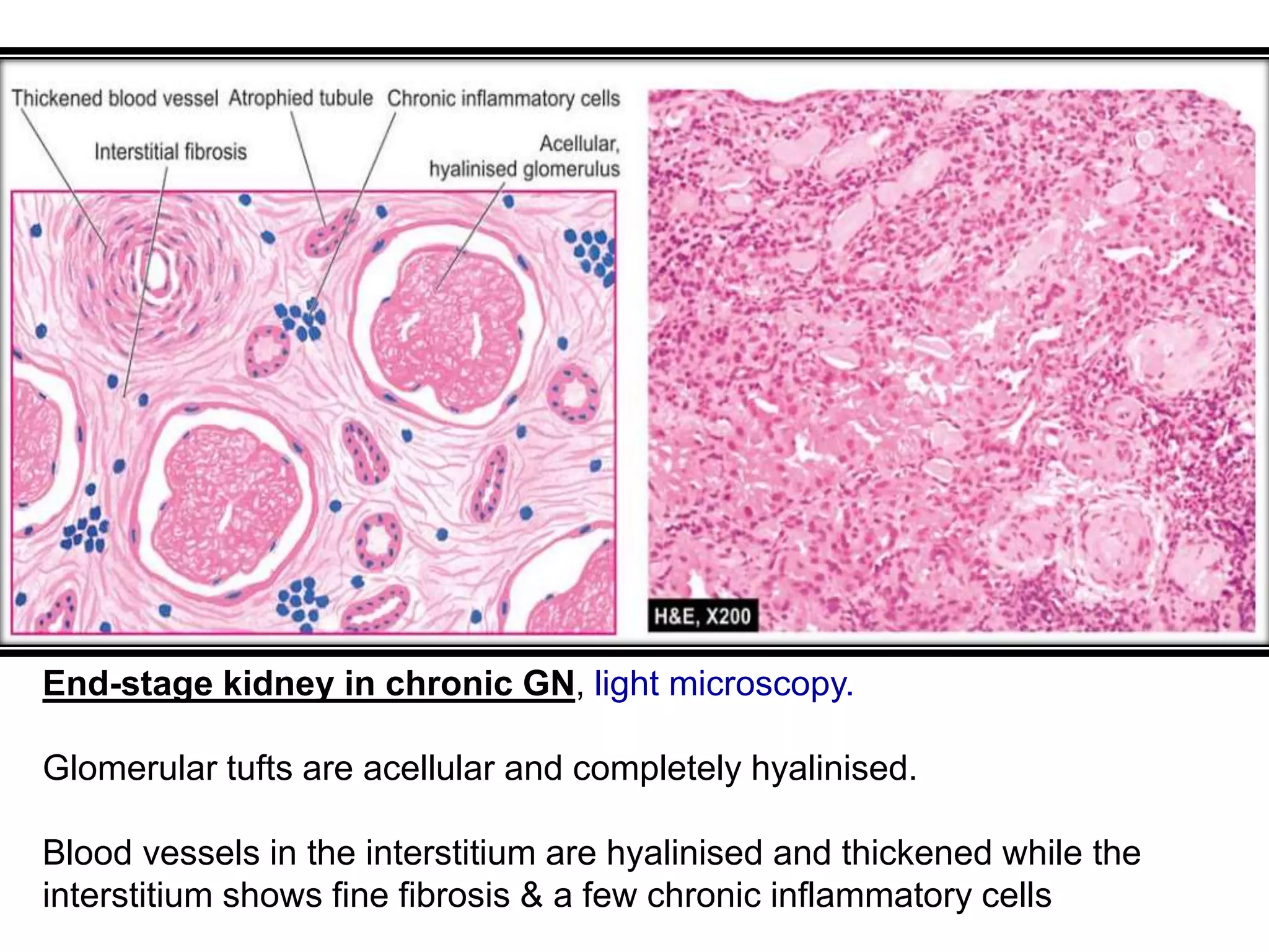 Chronic Glomerulonephritis | PPTX | Diseases and Conditions | Medical ...