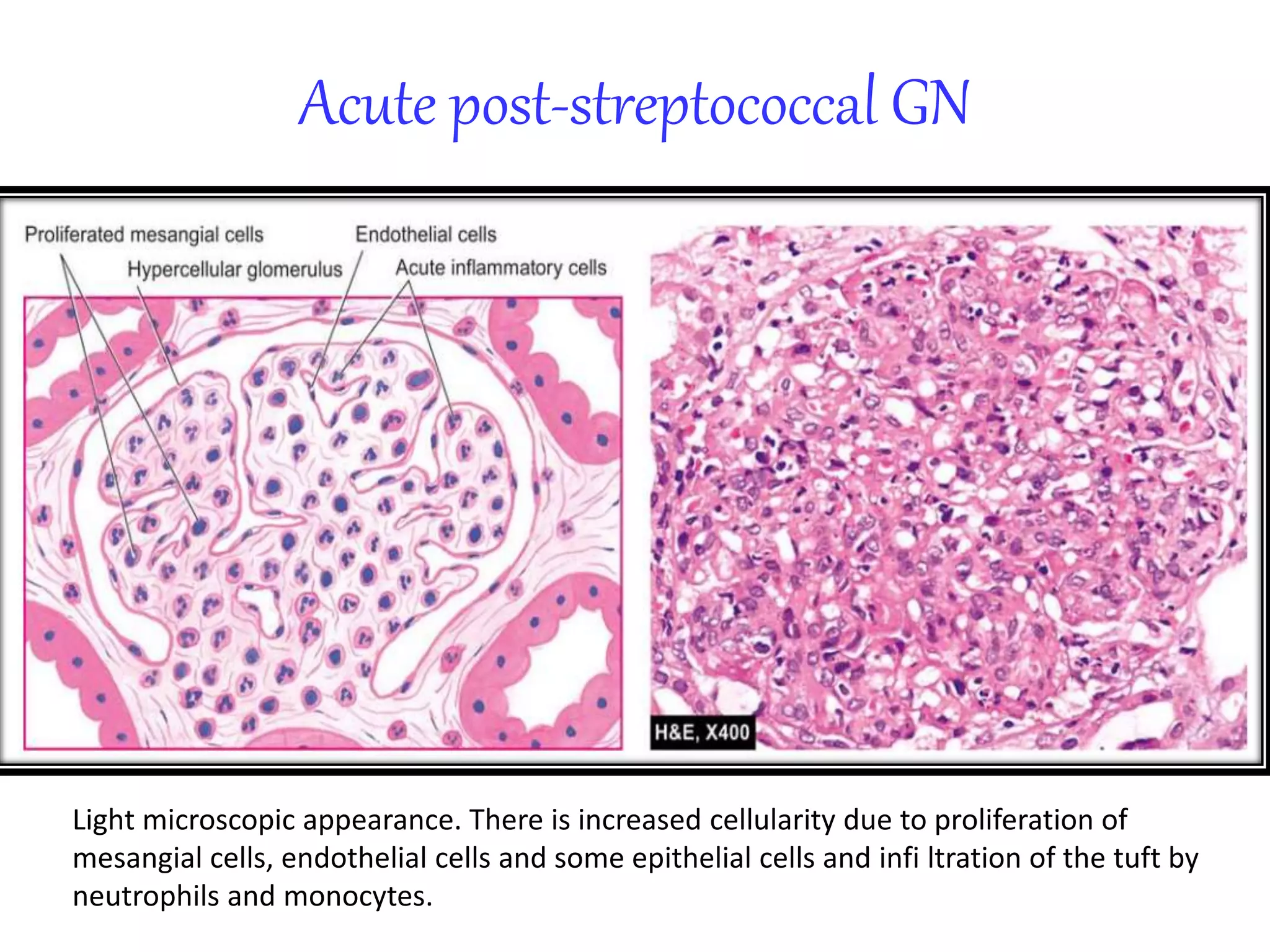 The KIDNEY: Acute Glomerulonephritis | PPT