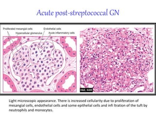 The KIDNEY: Acute Glomerulonephritis | PPT