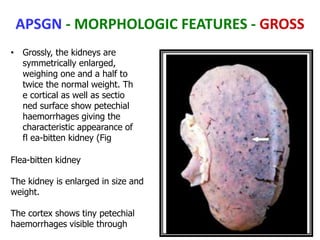 The KIDNEY: Acute Glomerulonephritis | PPT
