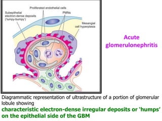 The KIDNEY: Acute Glomerulonephritis | PPT