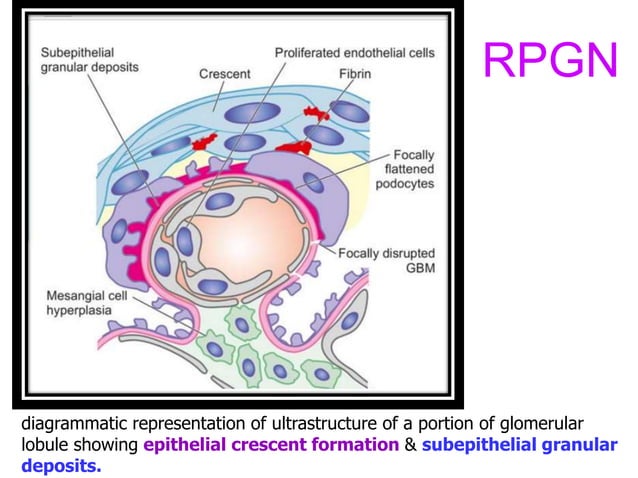 Rapidly Progressive Glomerulonephritis , RPGN, Crescentic GN ...