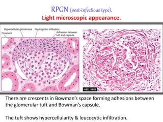 Rapidly Progressive Glomerulonephritis , RPGN, Crescentic GN ...