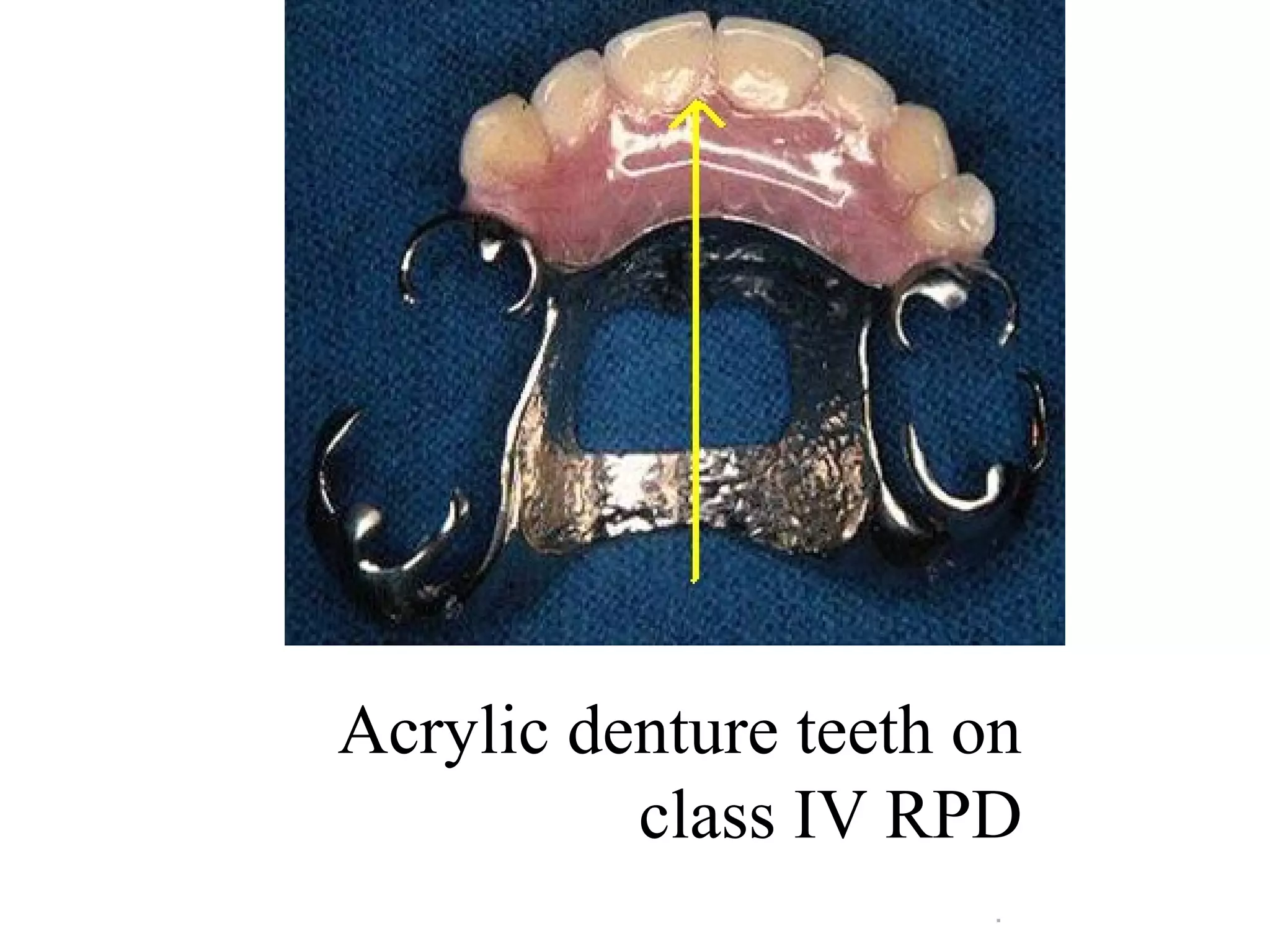 7 tooth selection for partial denture | PPT