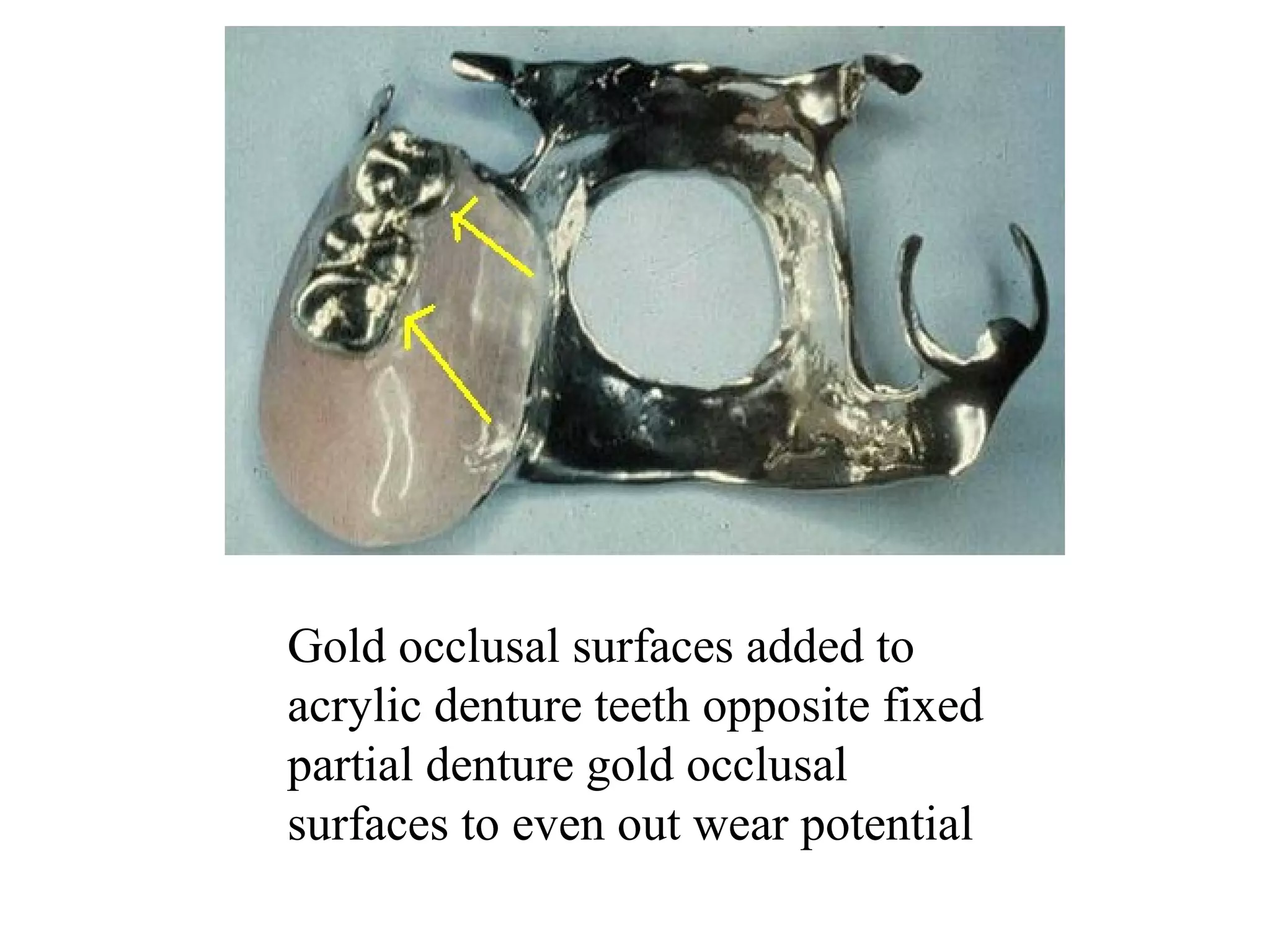 7 tooth selection for partial denture | PPT