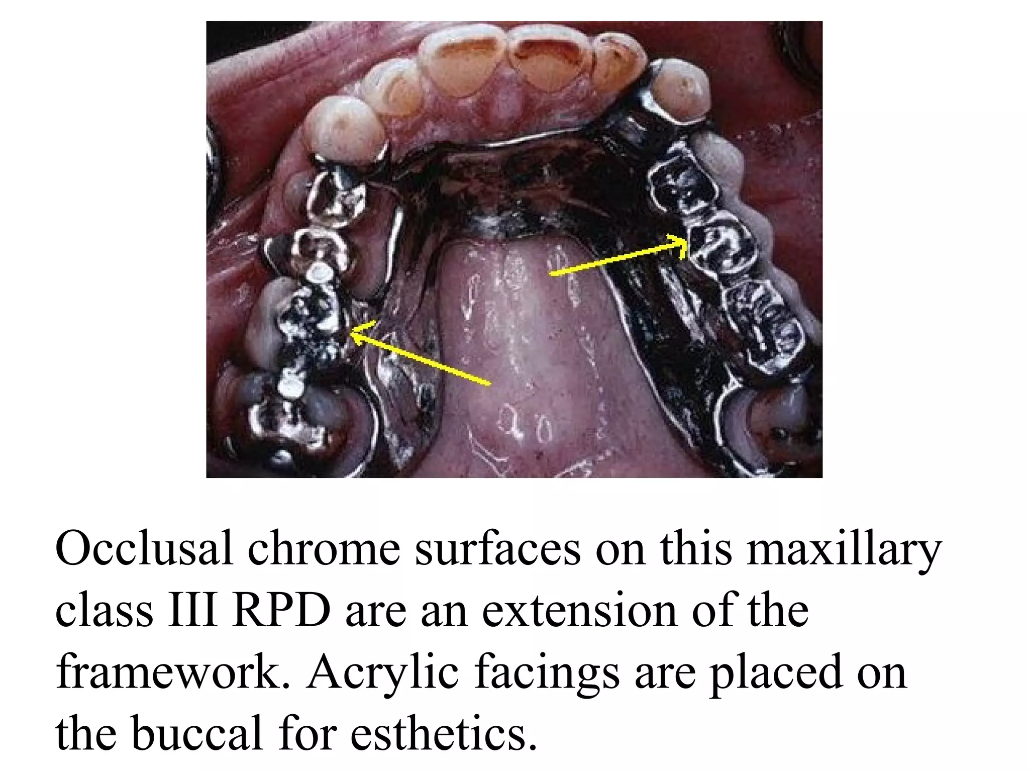 7 tooth selection for partial denture | PPT