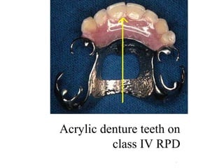 7 tooth selection for partial denture | PPT