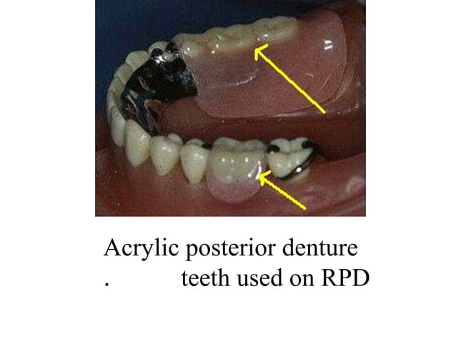 7 tooth selection for partial denture | PPT | Dental Health | Diseases ...